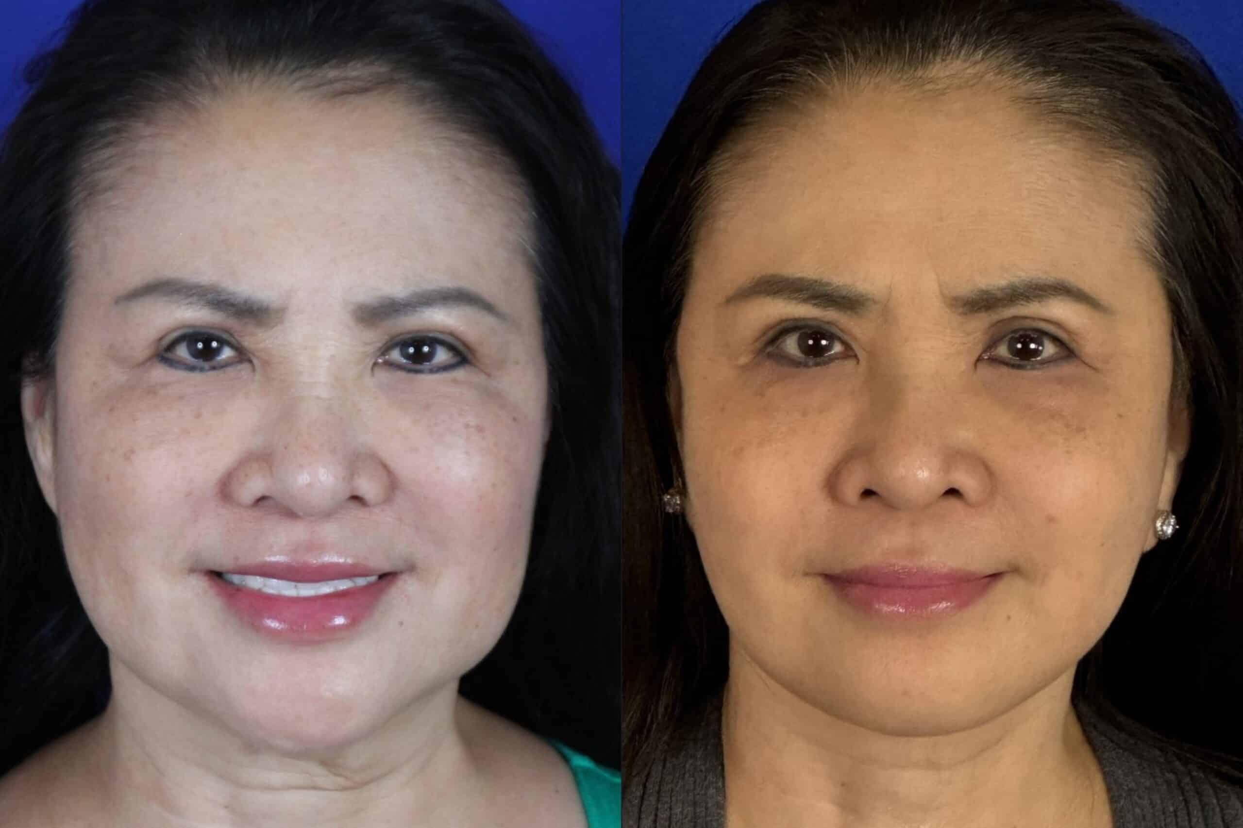 Jowls (lipo) Case Gallery